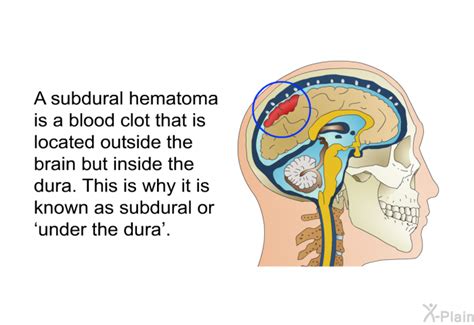 Craniotomy For Subdural Hematoma
