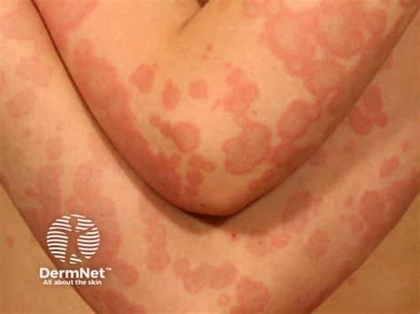 Erythema Multiforme Images
