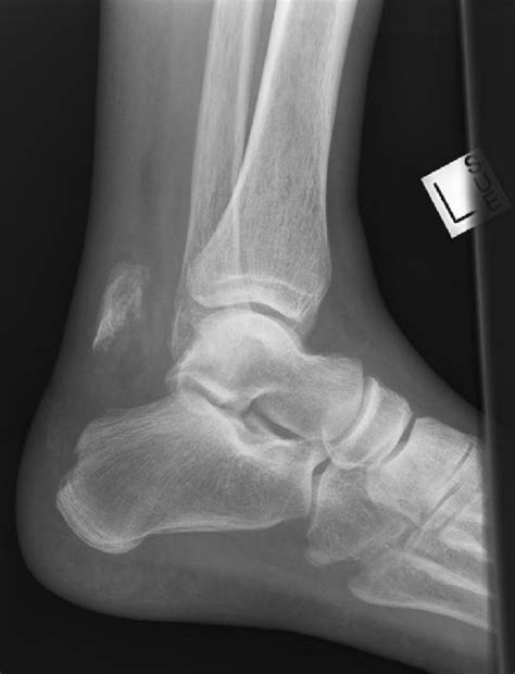 Calcaneus Fractures Trauma Orthobullets
