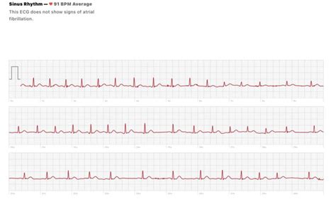 Was Told These Are Ectopic Atrial Beats Not Just Sinus Arrhythmia Thoughts R Readmyecg