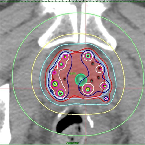 Dose Distribution For A Tumor In The Right Peripheral Zone At The Time
