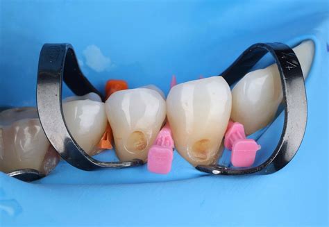 Zerodonto Photo 2 Showing A Healthy Gingiva Generalized Diffuse