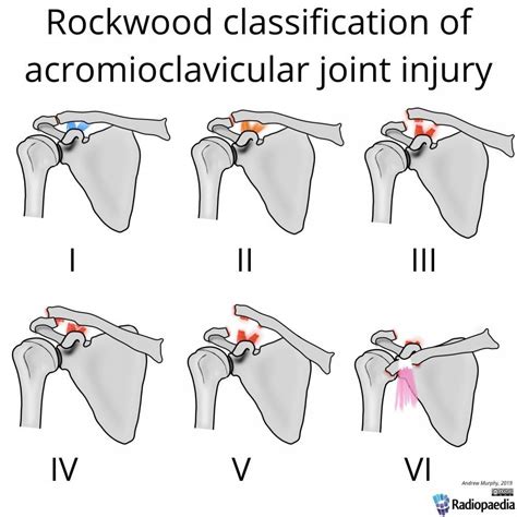 Acromioclavicular Joint Dislocation