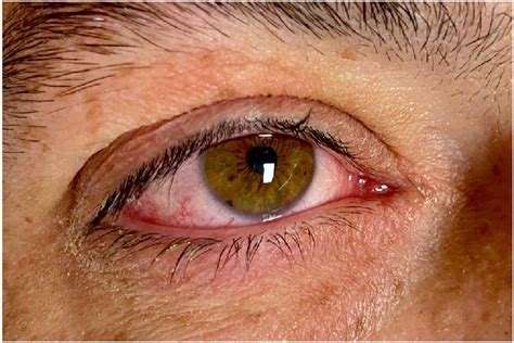 Right Eye Blepharoconjunctivitis With Conjunctival Hyperaemia And Mild Download Scientific