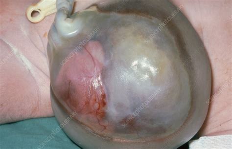 Exomphalos Stock Image C0366348 Science Photo Library