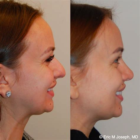 Eric M Joseph Md Rhinoplasty Before And After Results With A Droopy
