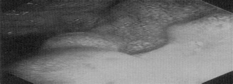 Nodular Duodenum After Pediatric Renal Transplant Due To Bru Journal Of Pediatric