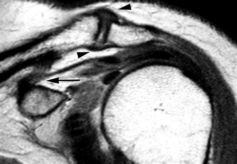 Mr Imaging Appearances Of Acromioclavicular Joint Dislocation