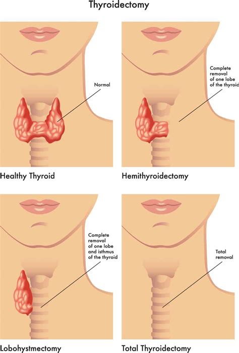 Thyroid Gland And Thyroidectomy Functions And Cpt Codes