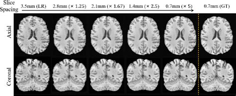 Figure 1 From Arbitrary Reduction Of Mri Inter Slice Spacing Using Hierarchical Feature