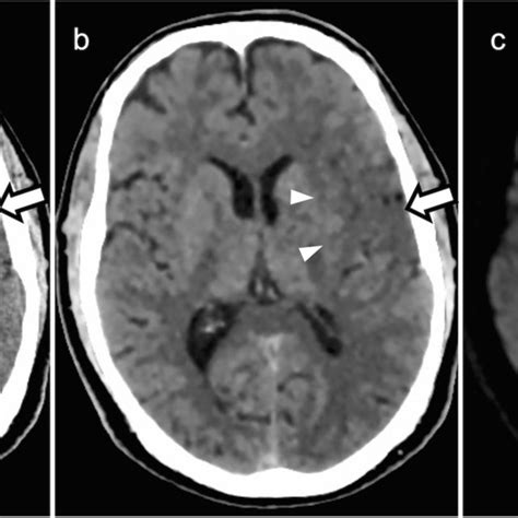 A 53 Year Old Man With Acute Ischemic Stroke In The Left Mca Territory Download Scientific