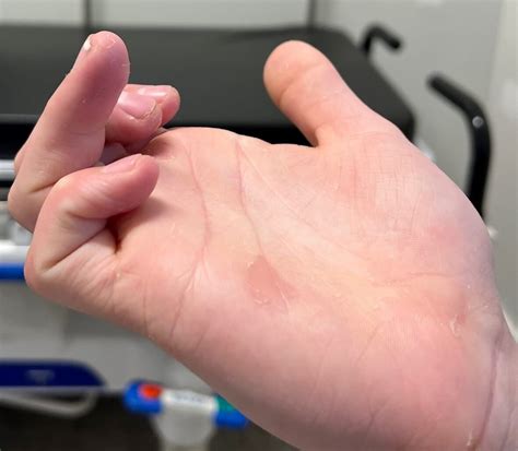 Orthodx Jersey Finger Clinical Advisor