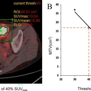 A a year old woman with left colon cancer ¹⁸F FDG PET CT showed Download Scientific