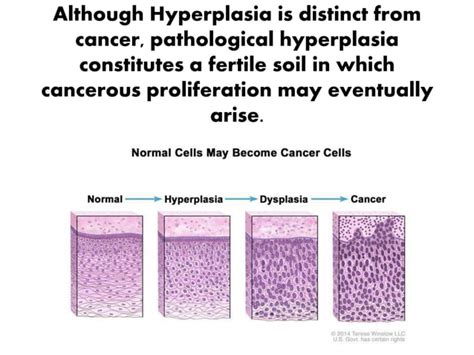 Hyperplasia Ppt