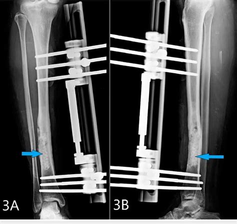 Post Operative X Ray Taken After Surgery Figures 3a 3b Show Download Scientific Diagram