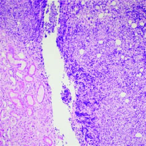 Low Grade G Neuroendocrine Tumor With Preserved And Well Download Scientific Diagram