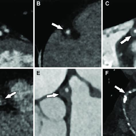 Perfusion Defect In A 54 Yearold Man With Chest Pain Short Axis A Download Scientific