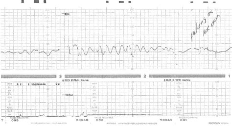 What Is A Sinusoidal Pattern