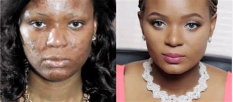 Clear Pimples Nigerian Finder