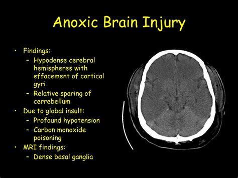 PPT Anoxic Brain Injury PowerPoint Presentation Free Download ID