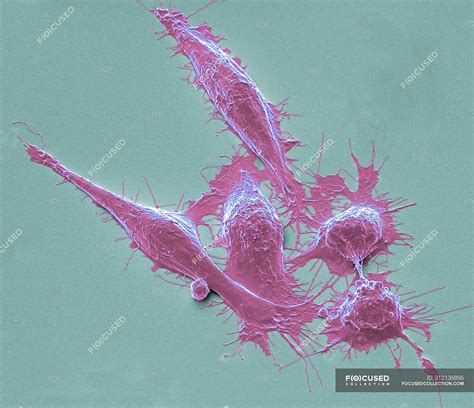 Coloured Scanning Electron Micrograph Of Cancer Cells From Colon
