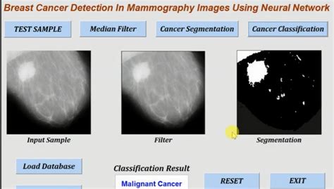 Breast Cancer Detection Tutorial To Mammography Analysis