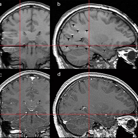 Examples Of Eeg Patterns Recorded From Intracranial Cortex And
