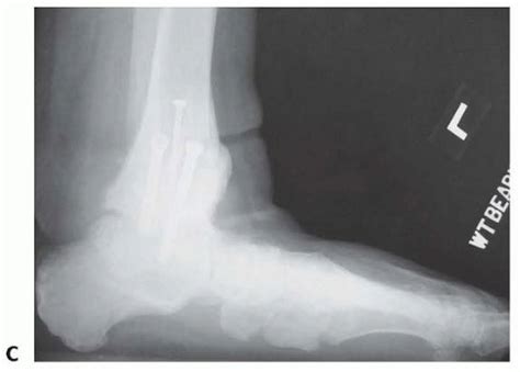 Tibiotalocalcaneal Arthrodesis Using A Medullary Nail Musculoskeletal Key