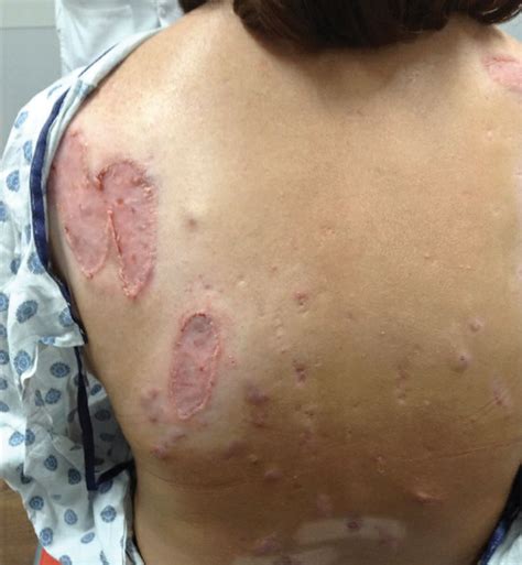 Long Term Remission Of Pyoderma Gangrenosum Acne And Hidradenitis Suppurativa Syndrome Mdedge