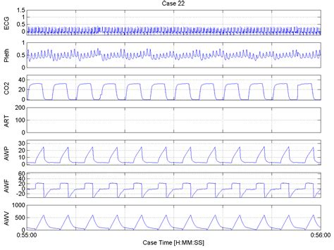 Case 22 Waveform Plots 60 Second Plots