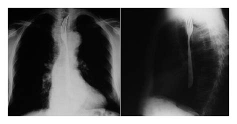 Unusual Esophageal Foreign Body A Table Fork Mevio 2013 Case