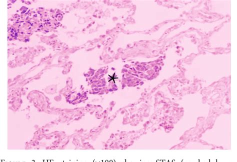 Figure 1 From Construction Of Pulmonary Nodule Ct Radiomics Random Forest Model Based On
