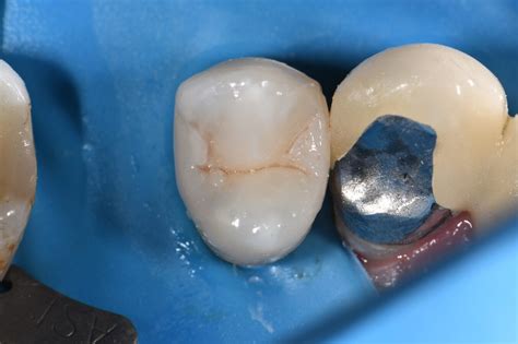 Matrix In Matrix Technique Class Ii Composite