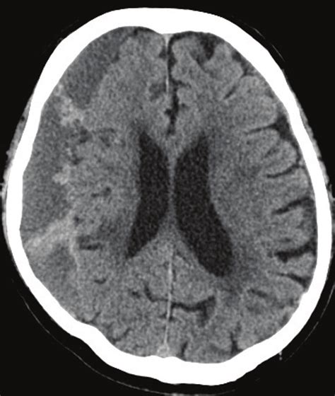 Ct Showing Recurrence Of Right Subdural Hematoma Download Scientific