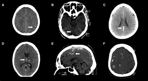 Cerebral Venous Thrombosis