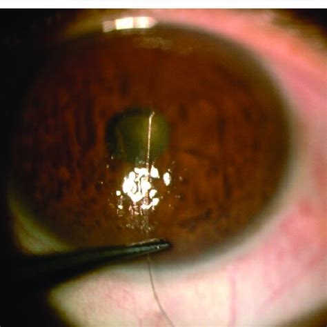 The Removed Eyelash Root Download Scientific Diagram