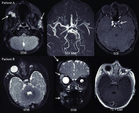 Phaces Syndrome With Multifocal Facial Haemangioma Narrowing Of The