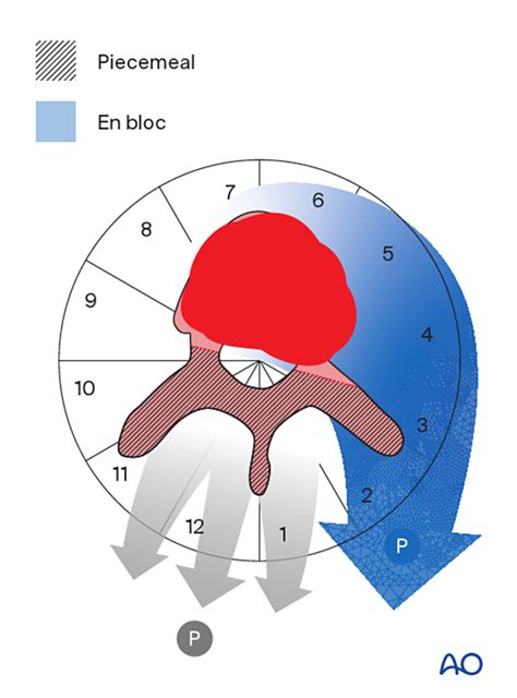 En Bloc Resection Of An Anterior Tumor T1 To T12 For Malignant