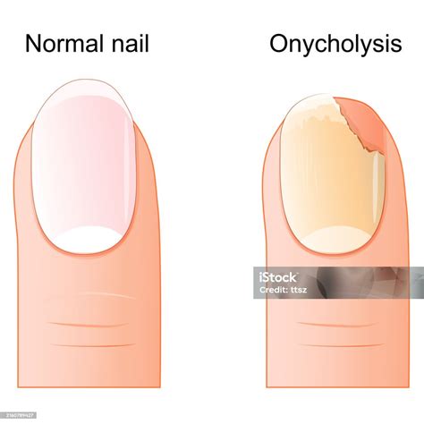 Onycholysis Detachment Of The Nail Plate Stock Illustration Download