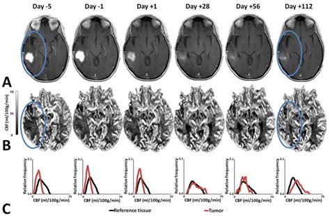 Increased Perfusion Representative Example Of A Patient With Perfusion Download Scientific