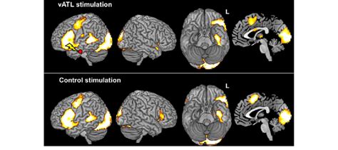 Brain Activation Maps Of The Synonymnumber Judgment Contrast For The Download Scientific