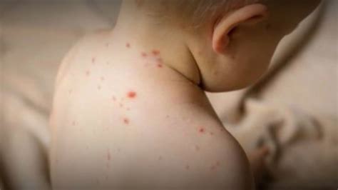 ეპიდემია ვაქცინის გარეშე ქვეყანაში ჩუტყვავილას და წითელას შემთხვევებმა უჩვეულოდ იმატა Youtube