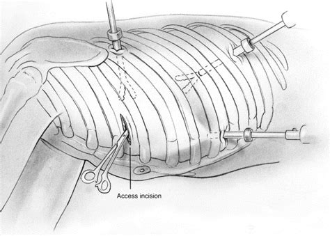 Lung Segmentectomy For Patients With Peripheral T1 Lesions Operative Techniques In Thoracic