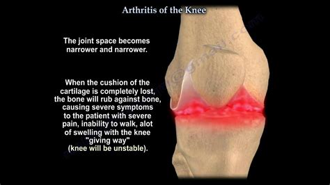 Osteoarthritis Knee Swelling