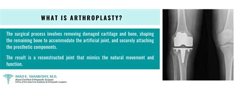 Navigating Orthopedic Choices Arthroplasty Or Arthroscopy Tarabishy