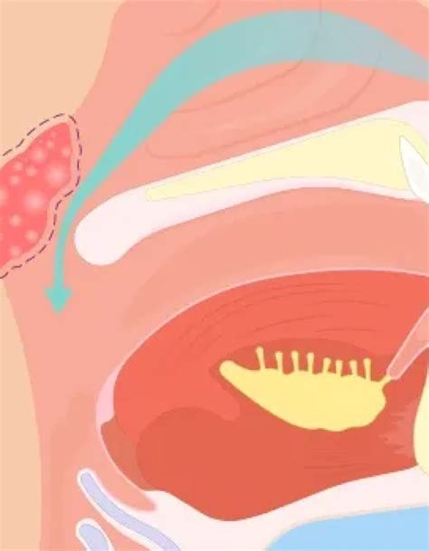 Homeopathic Treatment For Adenoid Hypertrophy