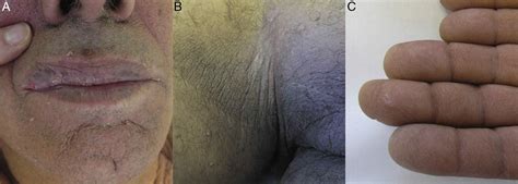 Malignant Acanthosis Nigricans Florid Cutaneous And Mucosal