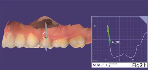 How To Ensure The Accuracy Of Scanned Occlusion Data