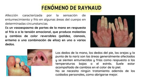 Fenómeno De Raynaud Ana María Ulloa Cavero Udocz