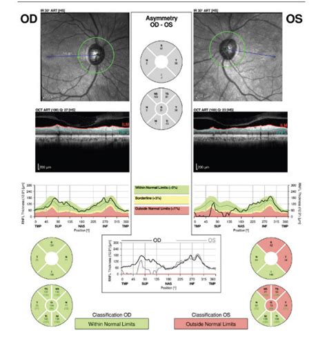 Rationalizing The Red When Rnfl Atrophy Is Not Glaucoma